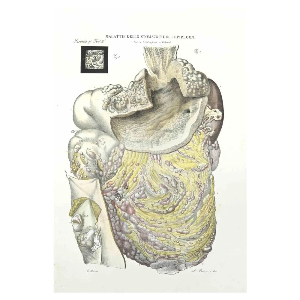 Ottavio Muzzi, Disease of the Stomach of Epiploon, Lithograph, 1843 ...